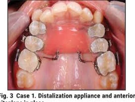 What Is Molar Distalizationsdcindia