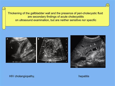 Ultrasound In Abdominal Emergencies Ppt