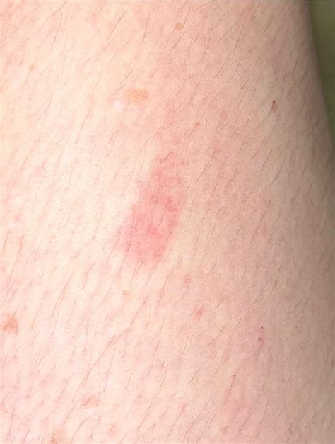 Is This Ringworm R Dermatology