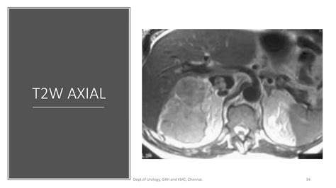 Clinical Features And Prognostic Factors Of Rcc Ppt