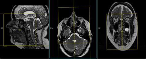 Trigeminal Nerve Mri