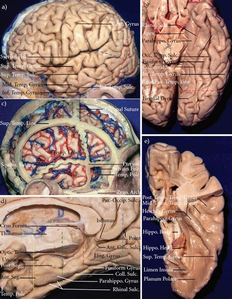 The Temporal Lobe Neuroanatomy The Neurosurgical Atlas