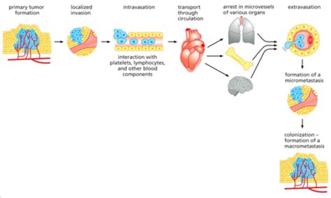 Lecture 6 Metastasis Flashcards Quizlet