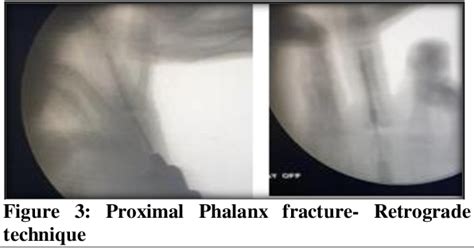 Figure 1 From Clinical And Radiological Outcome Of Intramedullary Cannulated Headless