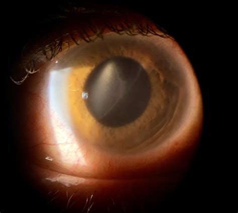 Eye Lens Dislocation Symptoms At Kathleen States Blog