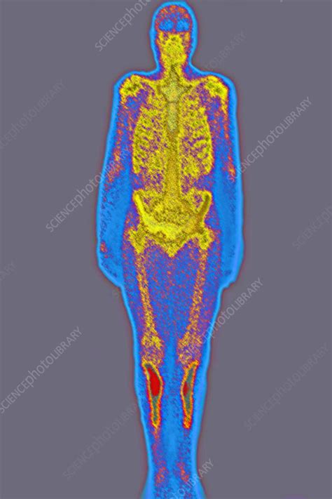 Stress Fractures Of Tibia Scintigraphy Stock Image C030 5667 Science Photo Library