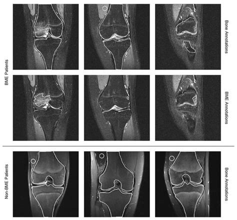 Learning Models For Bone Marrow Edema Detection In Magnetic Resonance Imaging