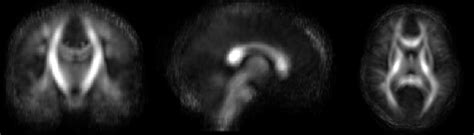 Dti Tutorial 2 Normalization And Statistics Diffusion Imaging