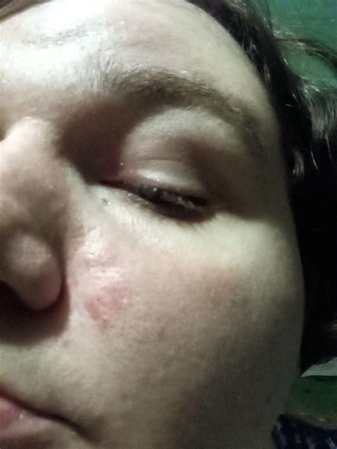 Issue After Squeezing Rskincareaddicts