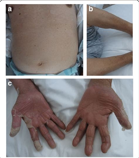 The Rash On The Patient S Trunk A And Both Lower Legs B Improved On Download Scientific