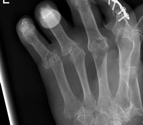 Rheumatoid Mcpj The Bone School