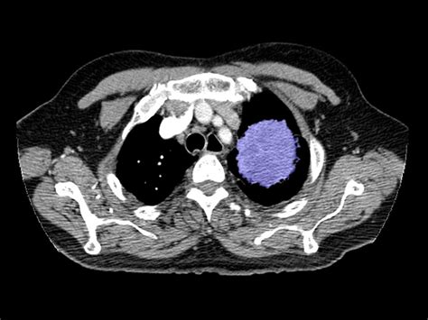 Lung Cancer Ct Scan