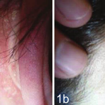 A Year Old Man With Scalp Psoriasis Before The Protocol Study B Download Scientific