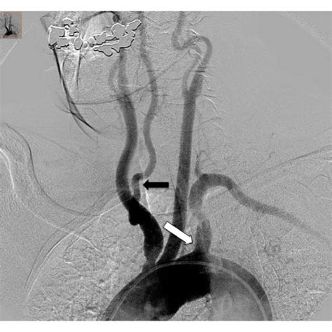 Retrograde Wire Passage From Right Brachial Access Through The