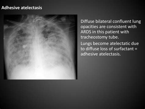 Tcm2 Radiology Pre Exam Review Semester One Chest X Ray Pathology Ppt