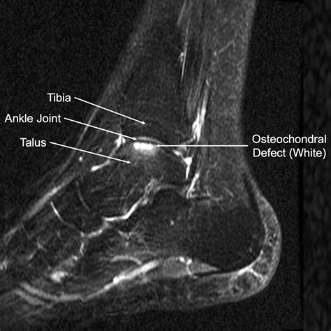 Osteochondral Defect — Daniel Bohl Md Midwest Orthopaedics At Rush