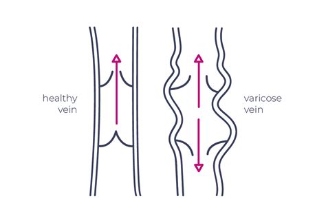 How Does Ultrasound Work In The Treatment Of Varicose Veins Echotherapy