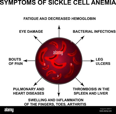 Sintomi Di Anemia Falciforme Mondo Anemia Falciforme Giorno Giugno Le Cellule Rosse Del