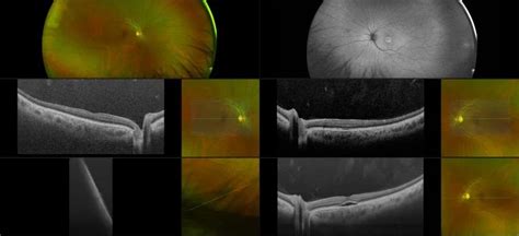 Central Serous Chorioretinopathy