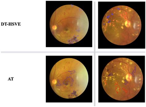 Exudate And Hemorrhage Segmentation Download Scientific Diagram