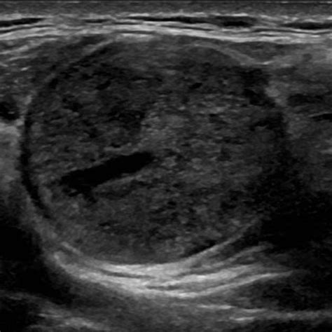 Pdf Angioleiomyoma Presenting As A Lateral Neck Lump A Diagnostic Dilemma