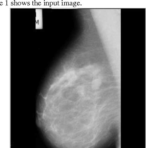 Figure 1 From Mammogram Image Segmentation Using Fuzzy Hybrid With Particle Swarm Optimization