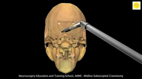 Neurosurgery 3d Animation Video Midline Suboccipital Craniotomy Youtube