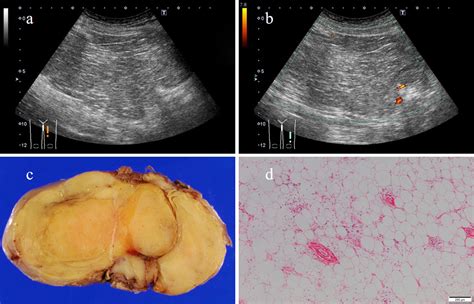 Sonographic Appearances Of Liposarcoma Correlations With Pathologic Subtypes Ultrasound In
