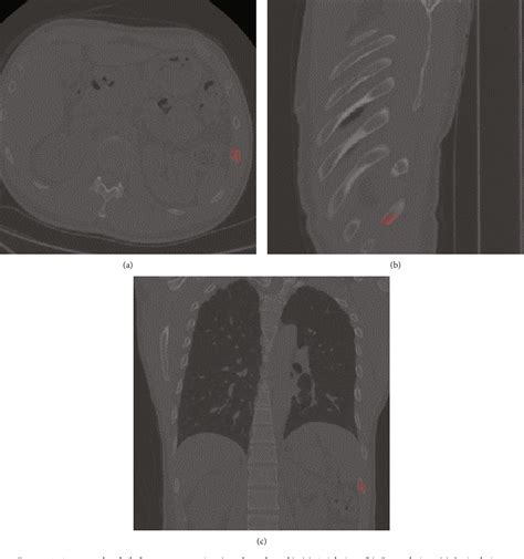Table 1 From Rib Fracture Detection With Dual Attention Enhanced U Net