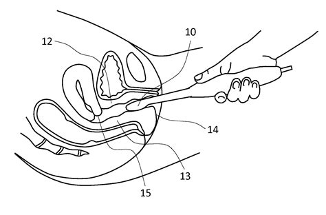 Patent US8052622 Methods For Characterizing Vaginal Tissue Elasticity Google Patents
