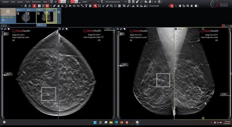 Contrast Enhanced Mammography Milford Live Local Delaware News Kent And Sussex Counties