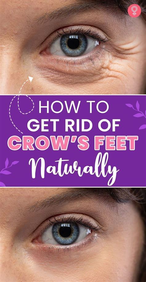 How To Get Rid Of Crows Feet 11 Ways And Prevention Tips Crows Feet Anti Aging Skin Products