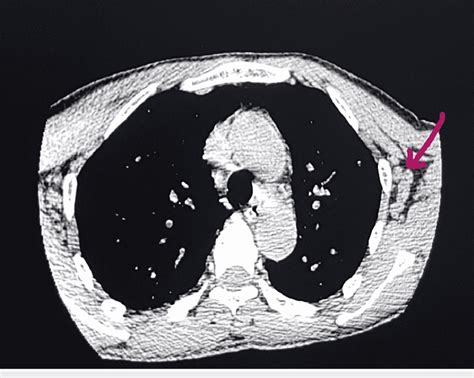 Multiple Axillary Lymph Nodes In The Left Axillary Region Arrow