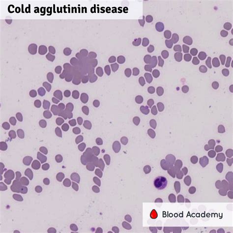 Transporting A Specimen For Cold Agglutinin Testing Includes At