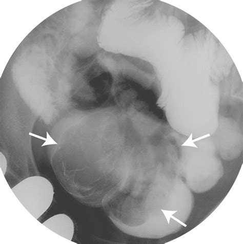 Ajr Teaching File Necrotic Mass Invading The Heart Ajr