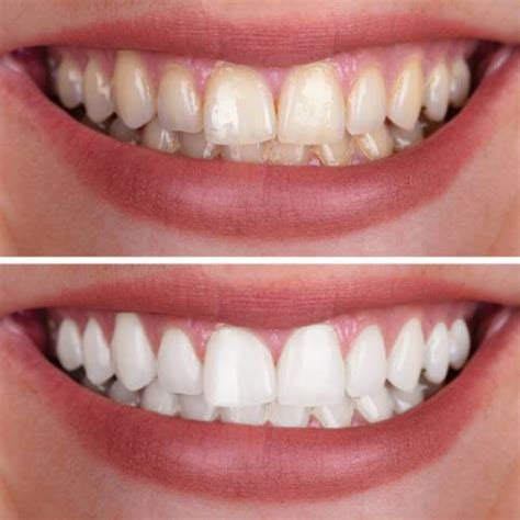 What Do Healthy Teeth Look Like 10 Signs Of Good Teeth