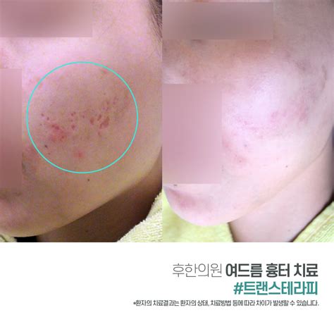 후한의원 부산 부산 서면 후한의원 여드름흉터치료 깊고 선명한 여드름흉터에 효과적인 트랜스테라피