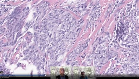 Clear Cell Sarcoma Dermpedia