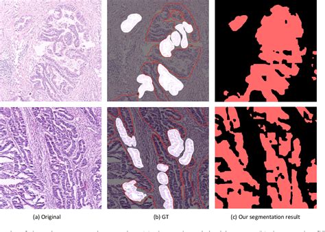 Figure 17 From Gastric Histopathology Image Segmentation Using A Hierarchical Conditional Random