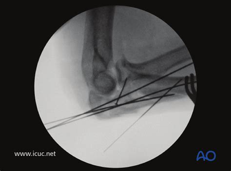 Open Reduction Internal Fixation For Anterior Transolecranon Fracture Dislocation