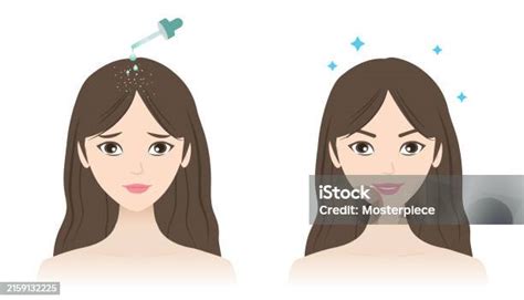 202406before And After Anti Dandruff Treatment Stock Illustration