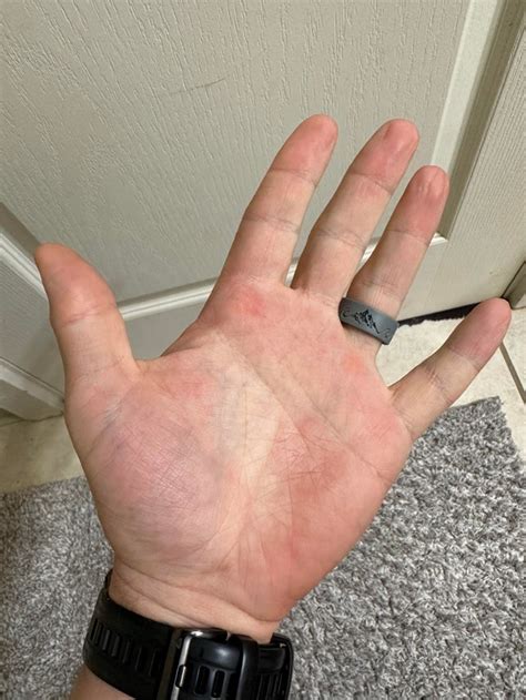 Help Identifying See Comment For Info R Scleroderma