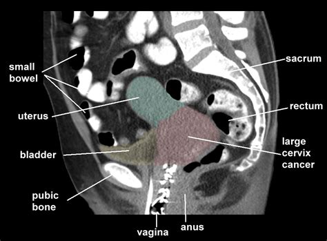 Uterus Ct Scan Labeled At Mildred Powell Blog