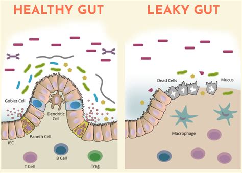 Gut Health And Type 2 Diabetes Mellitus All You Need To Know