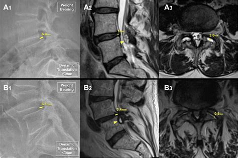 Evolution Of Lumbar Degenerative Spondylolisthesis With Key