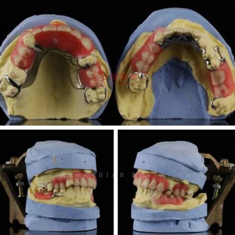 High Quality Dental Laboratory Denture Attachment 3d Metal Printed Partial Removable Denture