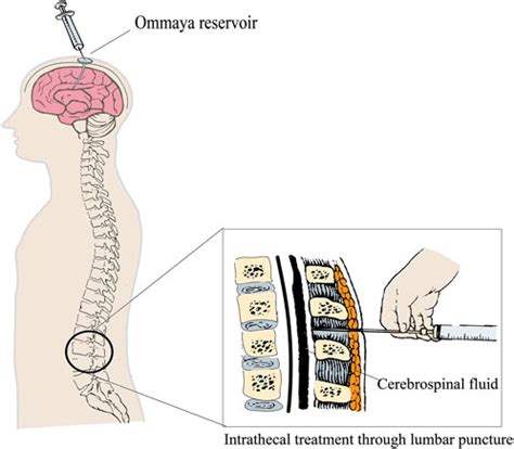 Frontiers A Review On Intrathecal Administration Of Medications For