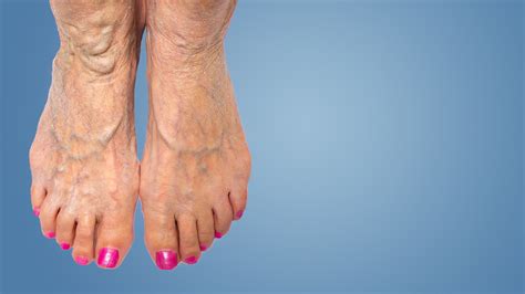 Varicose Veins Feet