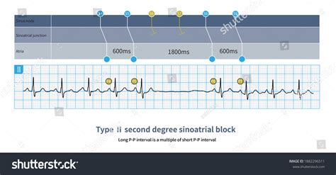 Type Second Degree Sinoatrial Block Long Stock Illustration 1882296511