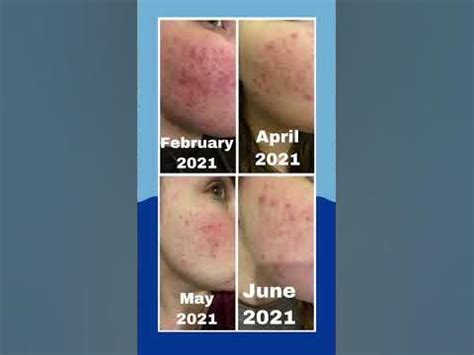Panoxyl Acne Foaming Wash Results Youtube